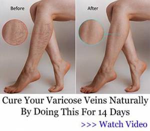 How To Treat Varicose Veins With Chestnuts - The Lost Herbs