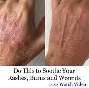 How to Make a Healing Soap for Eczema and Skin Rashes - The Lost Herbs