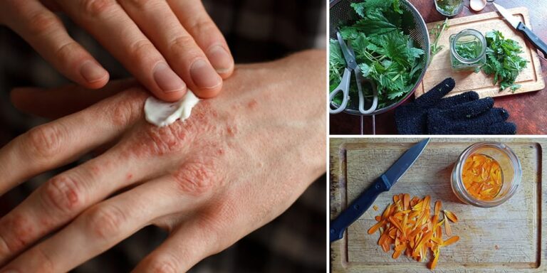Homemade Herbal Rub for Eczema & Psoriasis - The Lost Herbs
