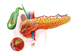 10 Warning Signs Your Pancreas Is In Trouble and When Should You Follow ...