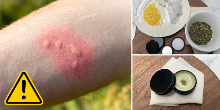 Here’s What Getting Stung By Nettles Does to Your Body - The Lost Herbs