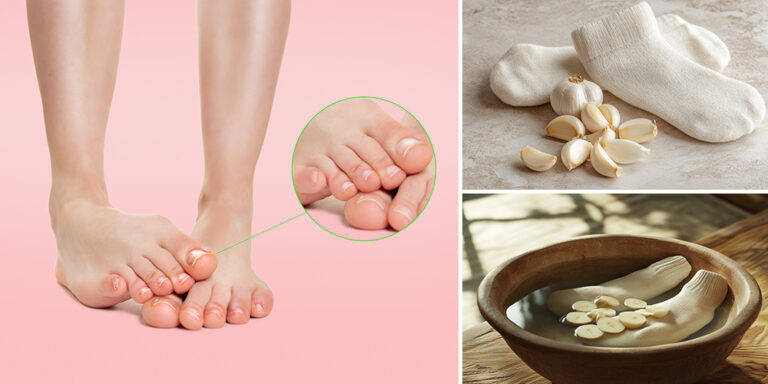 DIY Anti-Fungal Garlic Socks - The Lost Herbs